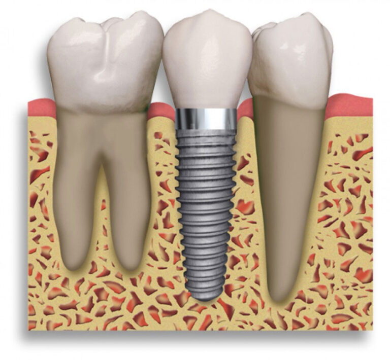 Best Dental Implants in Girgaon, South Mumbai| 3A Dental Clinic